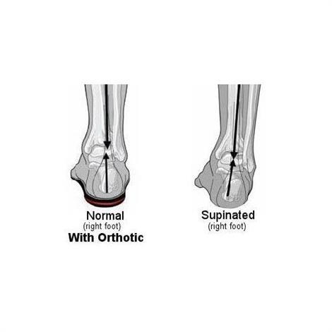 Buy Vasyli Hoke Supination Insole | Orthotics For Supination