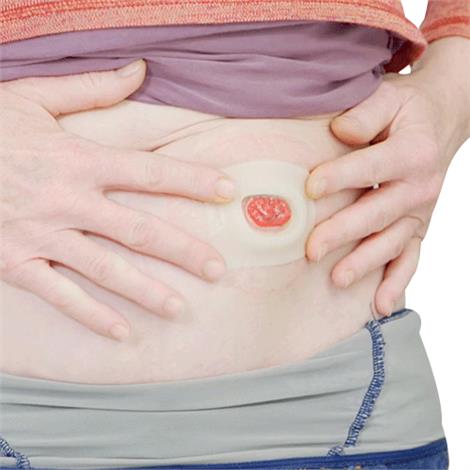 Trio Silvex Silicone Convex Ostomy Seal | Seals and Barrier Rings